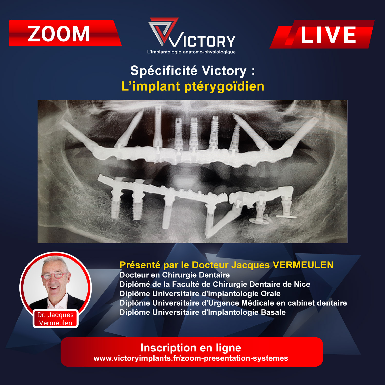 ZOOM présentation systèmes - Victory Implants