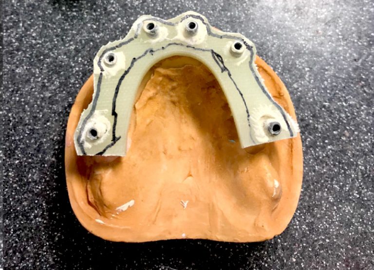 Zantex une nouvelle technologie innovante - Victory Implants