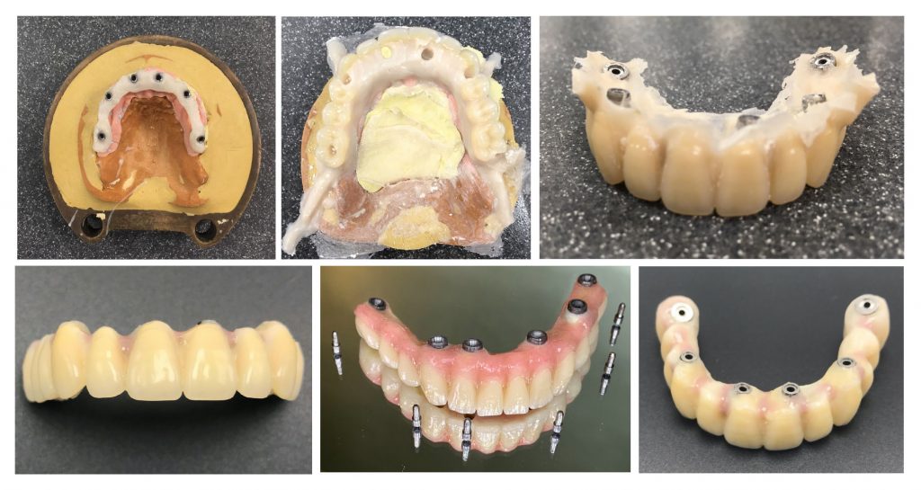 Zantex une nouvelle technologie innovante - Victory Implants